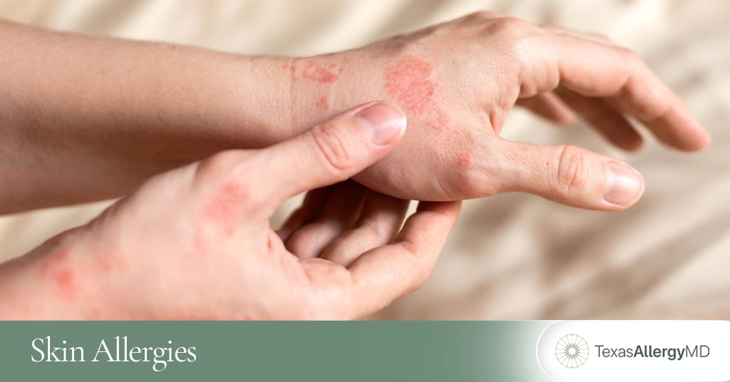Human Skin Allergies Urticaria And Other Skin Allergy | Allergy UK